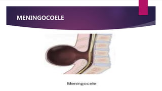 Spina bifida ppt | PPTX