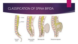 Spina bifida ppt | PPTX