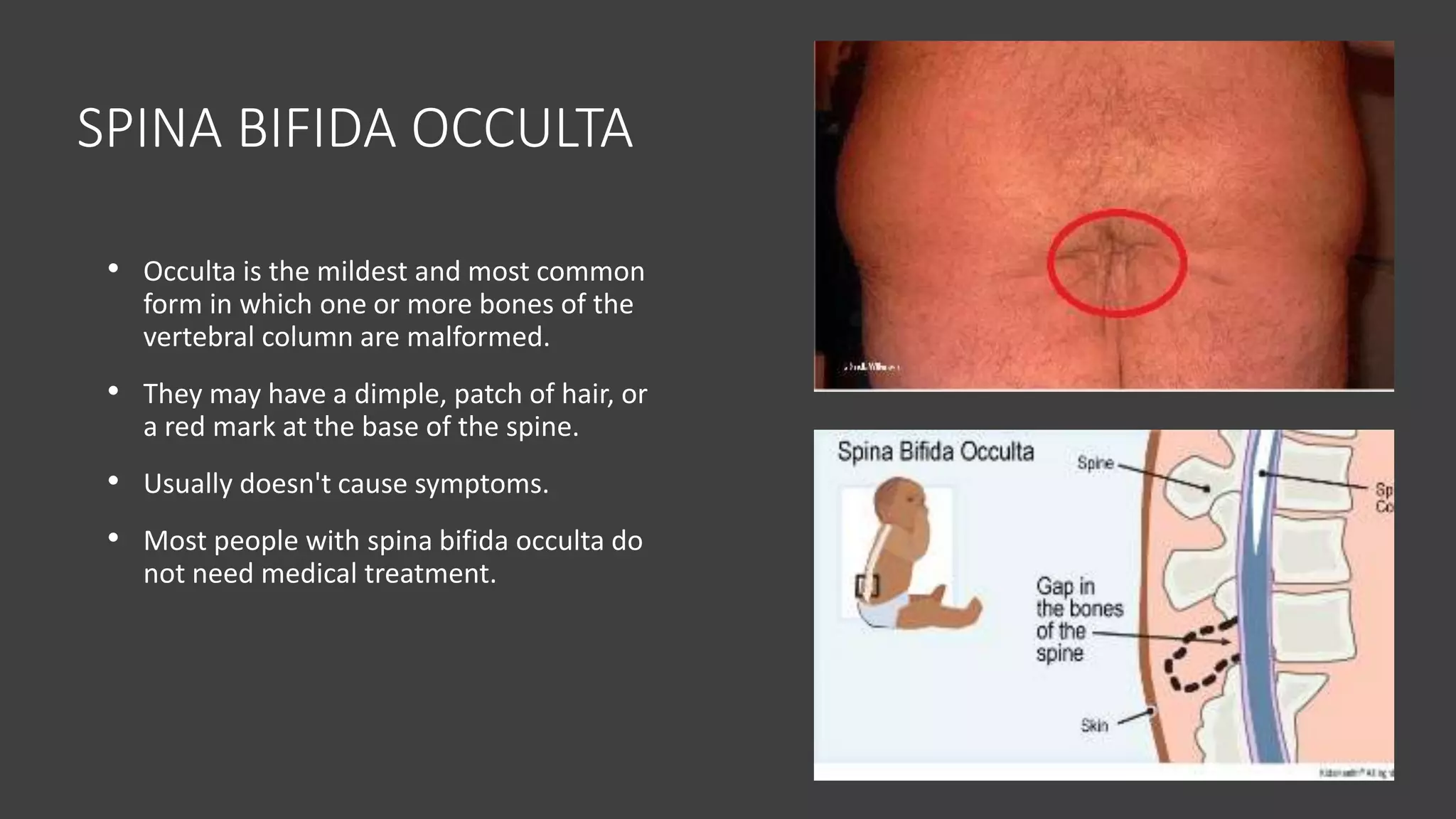 spina bifida presentation | PPTX