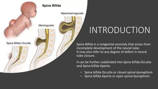 spina bifida presentation | PPTX | Pregnancy | Reproductive Health