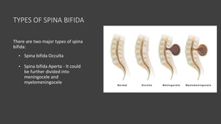 spina bifida presentation | PPT