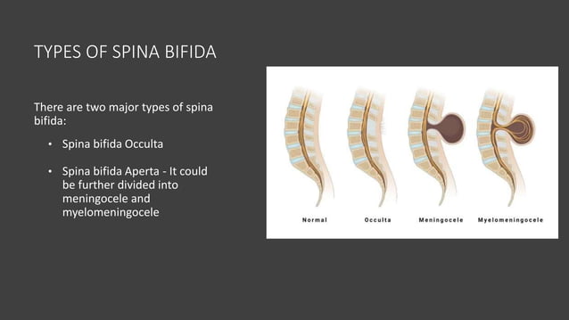 spina bifida presentation | PPTX | Pregnancy | Reproductive Health