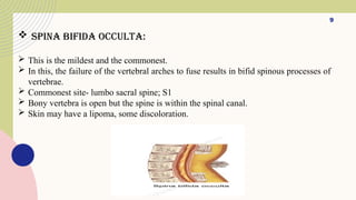 SPINA BIFIDA ppt.pptx upload powerpoint presentation | PPTX