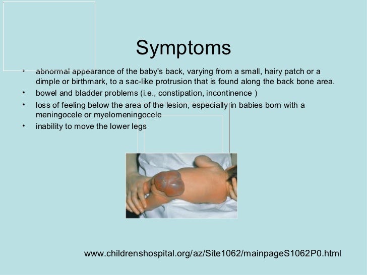 Spina bifida syndrome p3