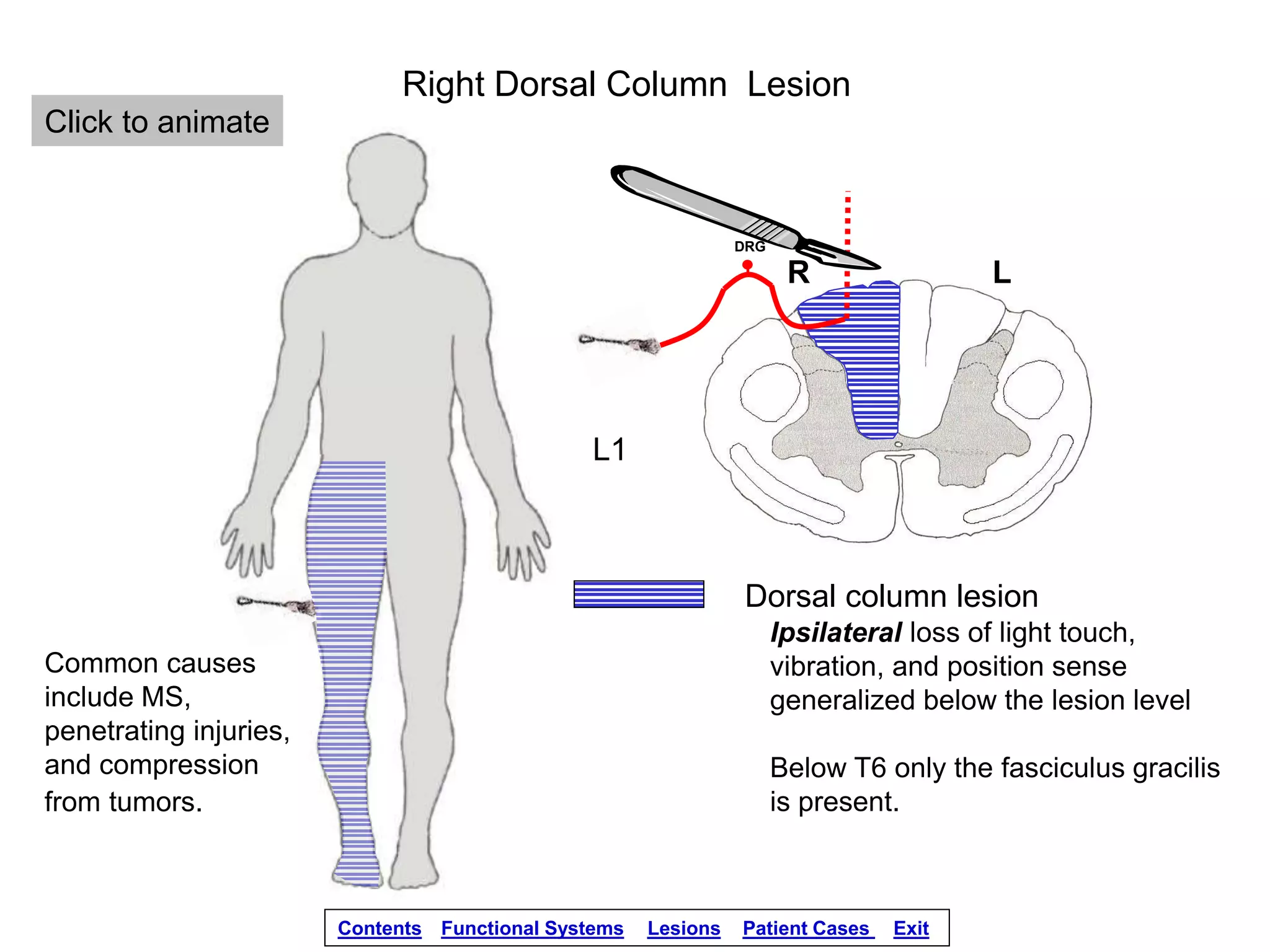 spinal-cord-injury-lesions.ppsx