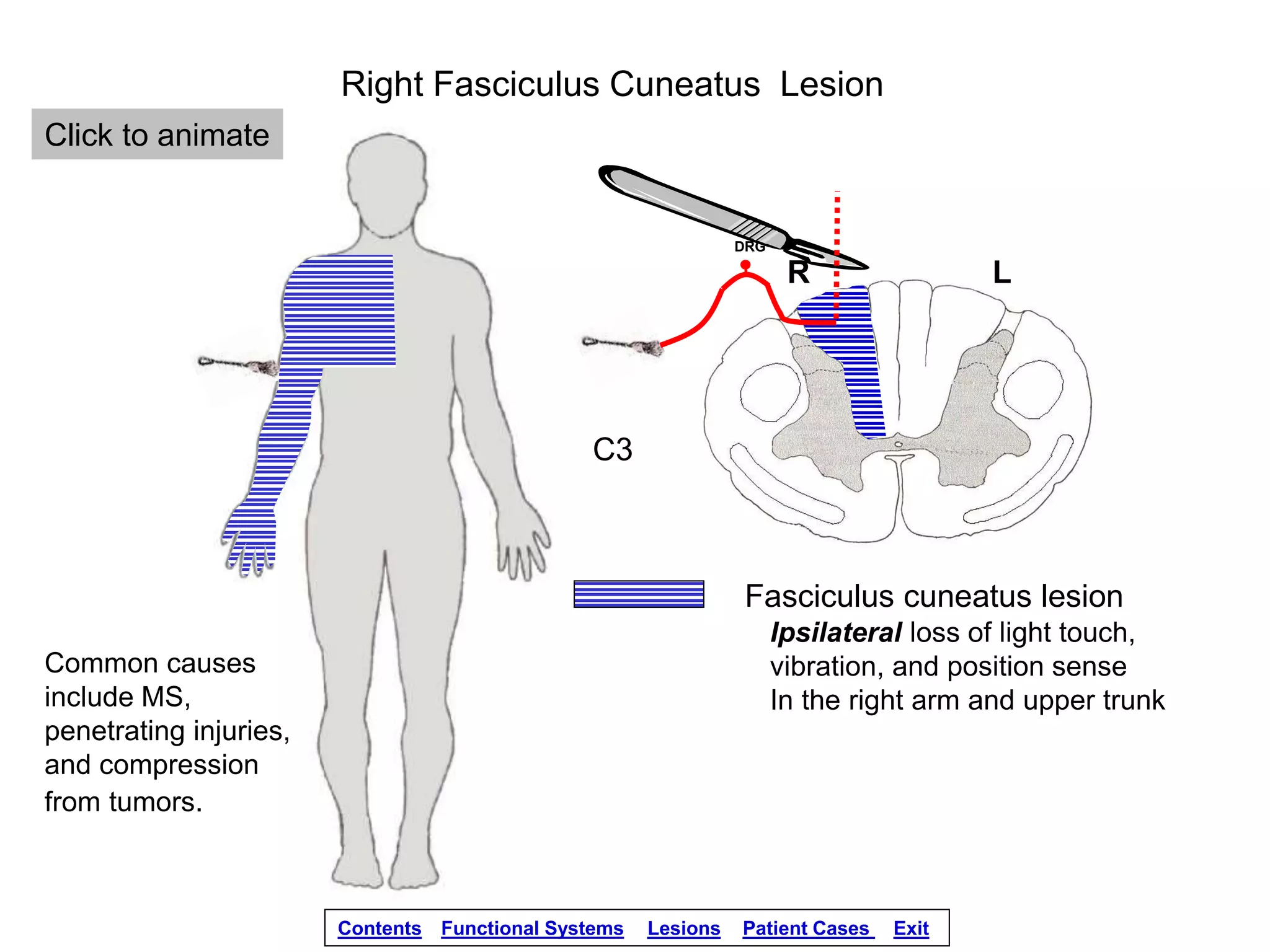 spinal-cord-injury-lesions.ppsx