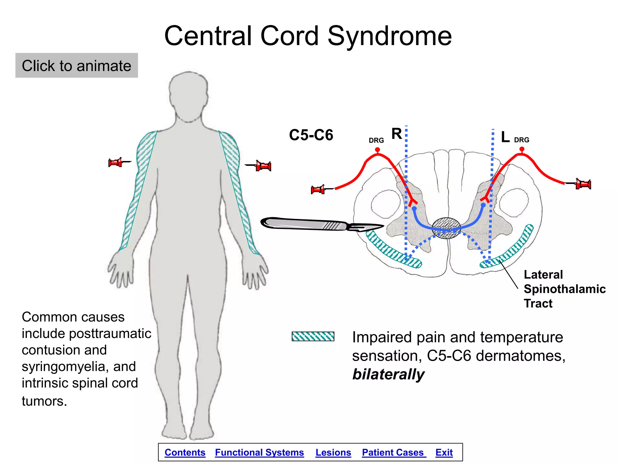 spinal-cord-injury-lesions.ppsx
