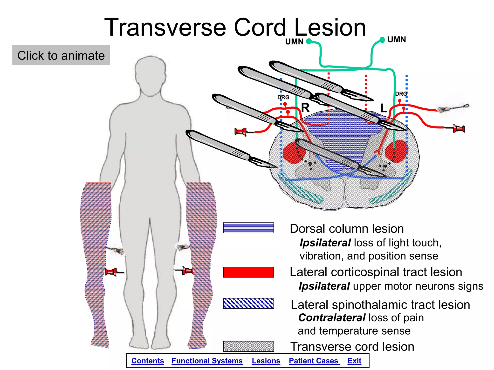 spinal-cord-injury-lesions.ppsx