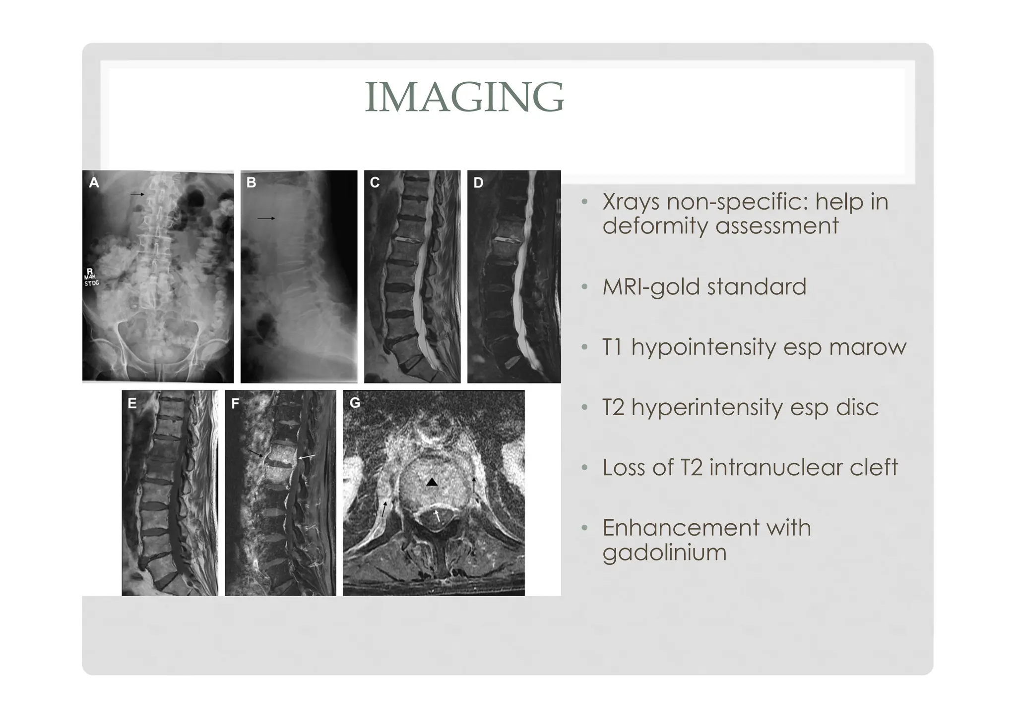 Spinal-Infections.pdf.................... | PDF | Bone and Joint ...
