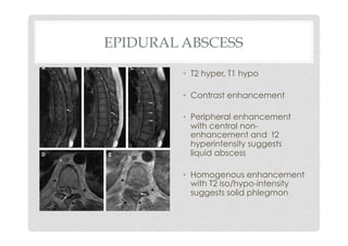 Spinal-Infections.pdf.................... | PDF | Bone and Joint ...