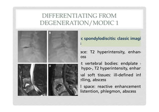 Spinal-Infections.pdf.................... | PDF | Bone and Joint ...