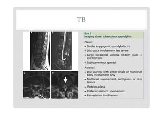 Spinal-Infections.pdf.................... | PDF
