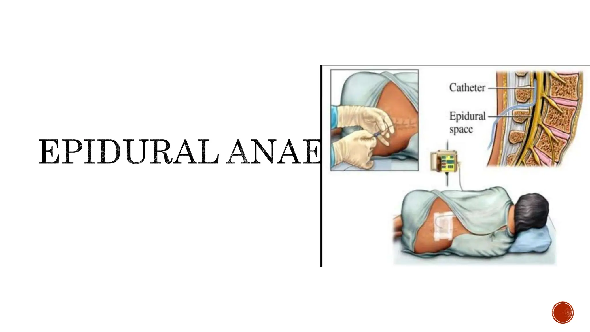 Epidural and spinal anesthesia are types of regional anesthesia that ...