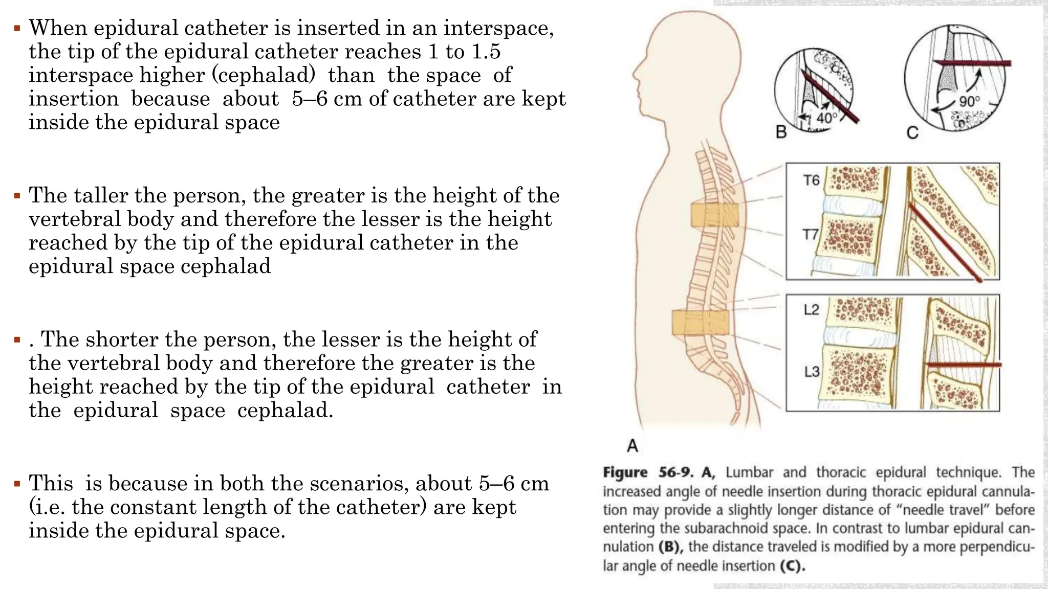 Epidural and spinal anesthesia are types of regional anesthesia that ...