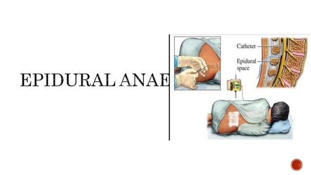 Epidural and spinal anesthesia are types of regional anesthesia that ...