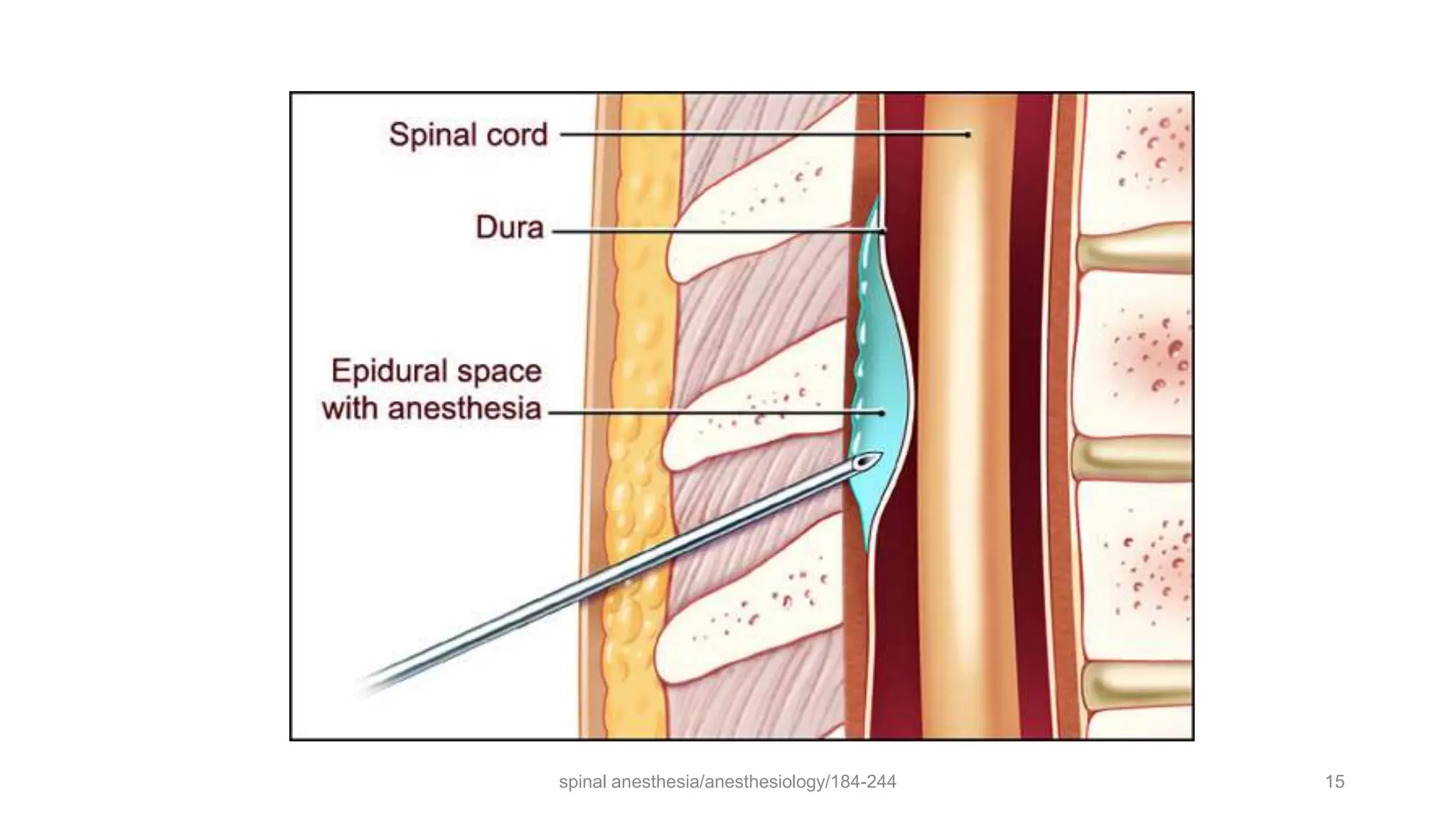 SPINAL ANAESTHESIA Anaesthesiology .pptx