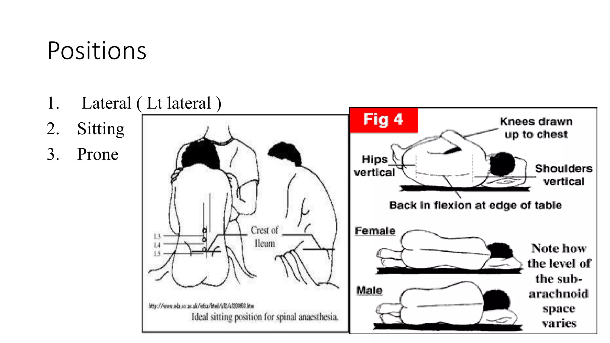 Spinal anaesthesia basics | PPTX