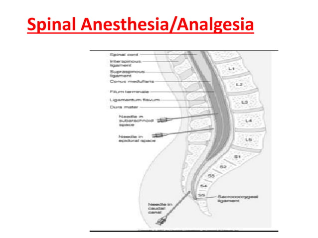 Spinal_Anaesthesia copy.pptx