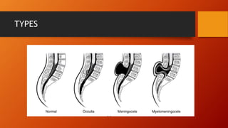 I LOVE NEUROSURGERY INITIATIVE: SPINAL AND CRANIAL DYSRAPHISM.pptx