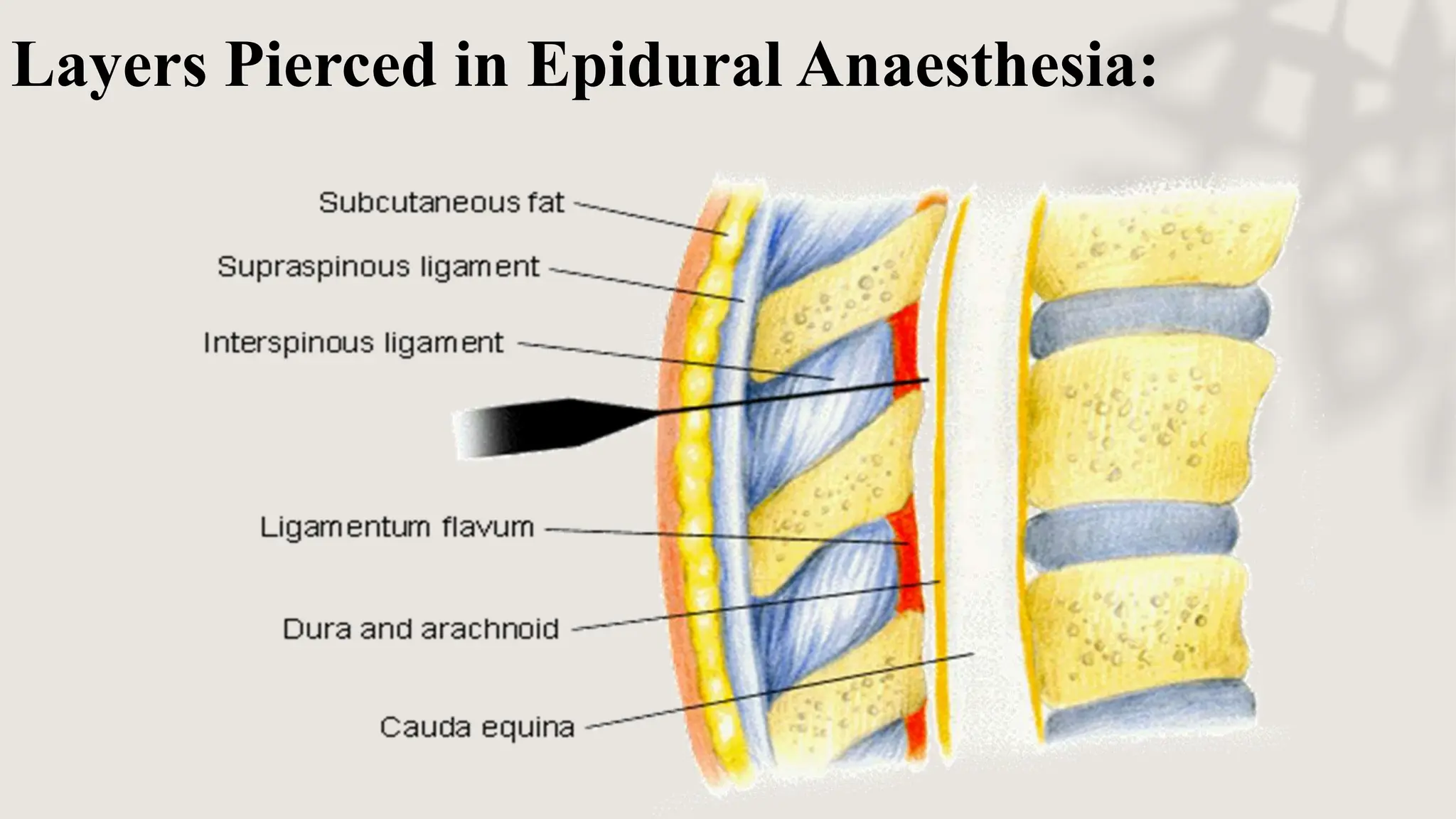 Spinal and Epidural Anaesthesia 5 1.pptx