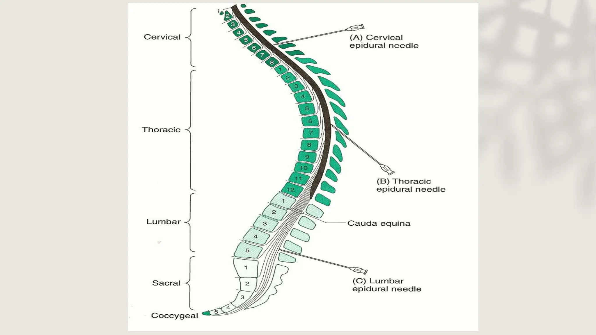 Spinal and Epidural Anaesthesia 5 1.pptx