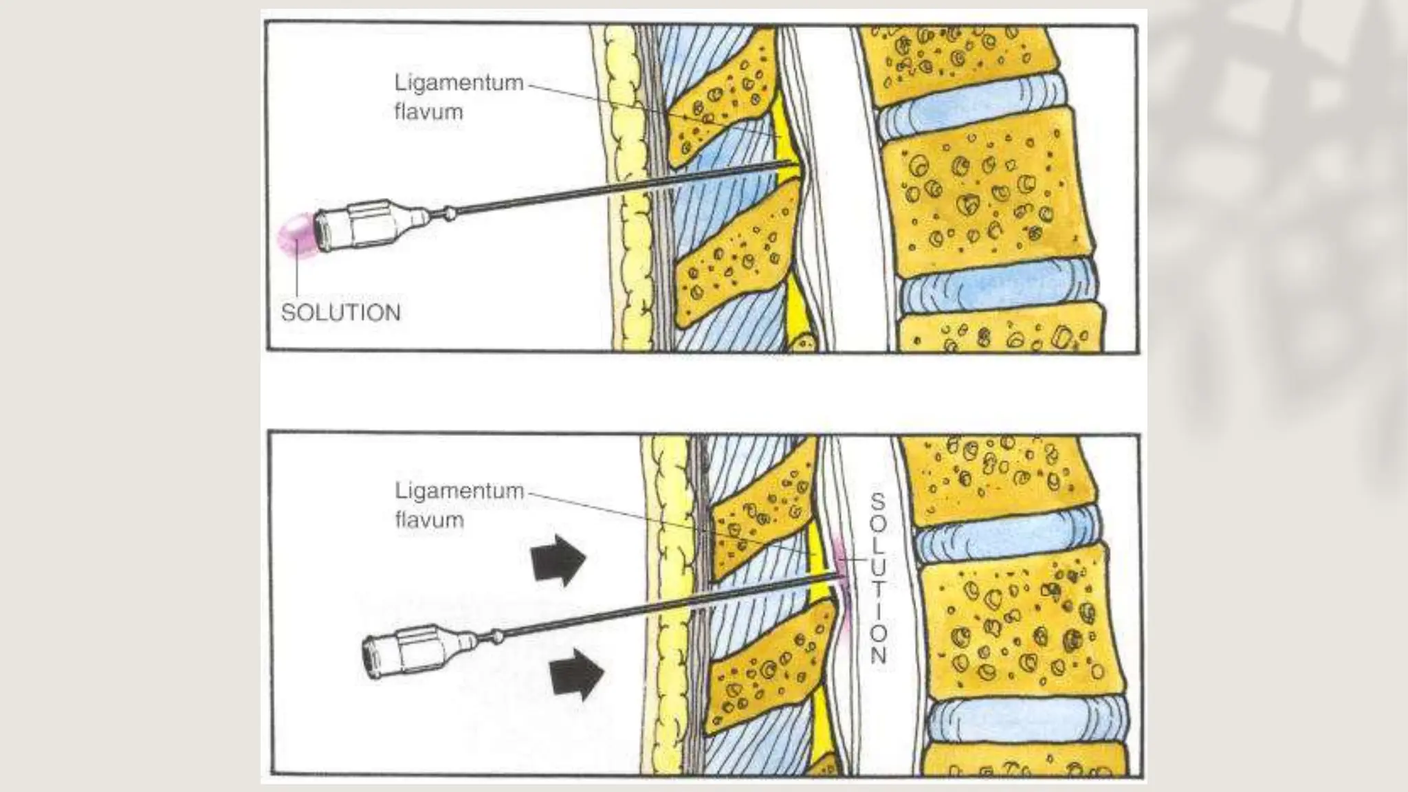 Spinal and Epidural Anaesthesia 5 1.pptx