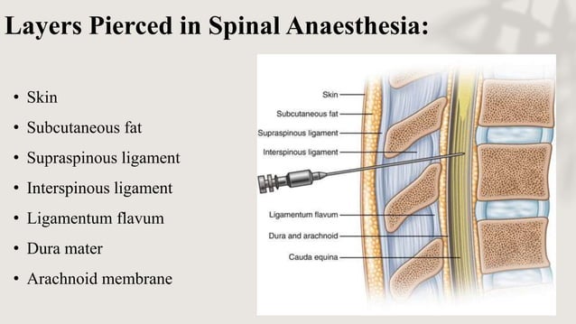 Spinal and Epidural Anaesthesia 5 1.pptx | First Aid | Injuries