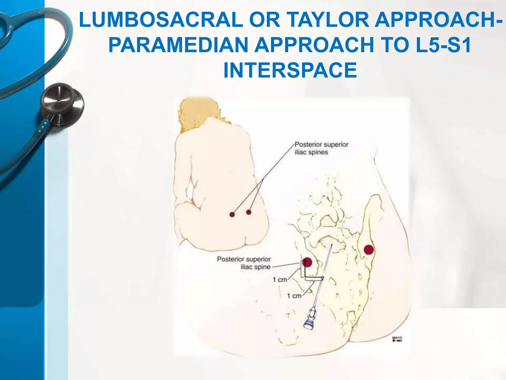 SPINAL AND EPIDURAL ANESTHEISA by Dr.Sravani Vishnubhatla | PPTX