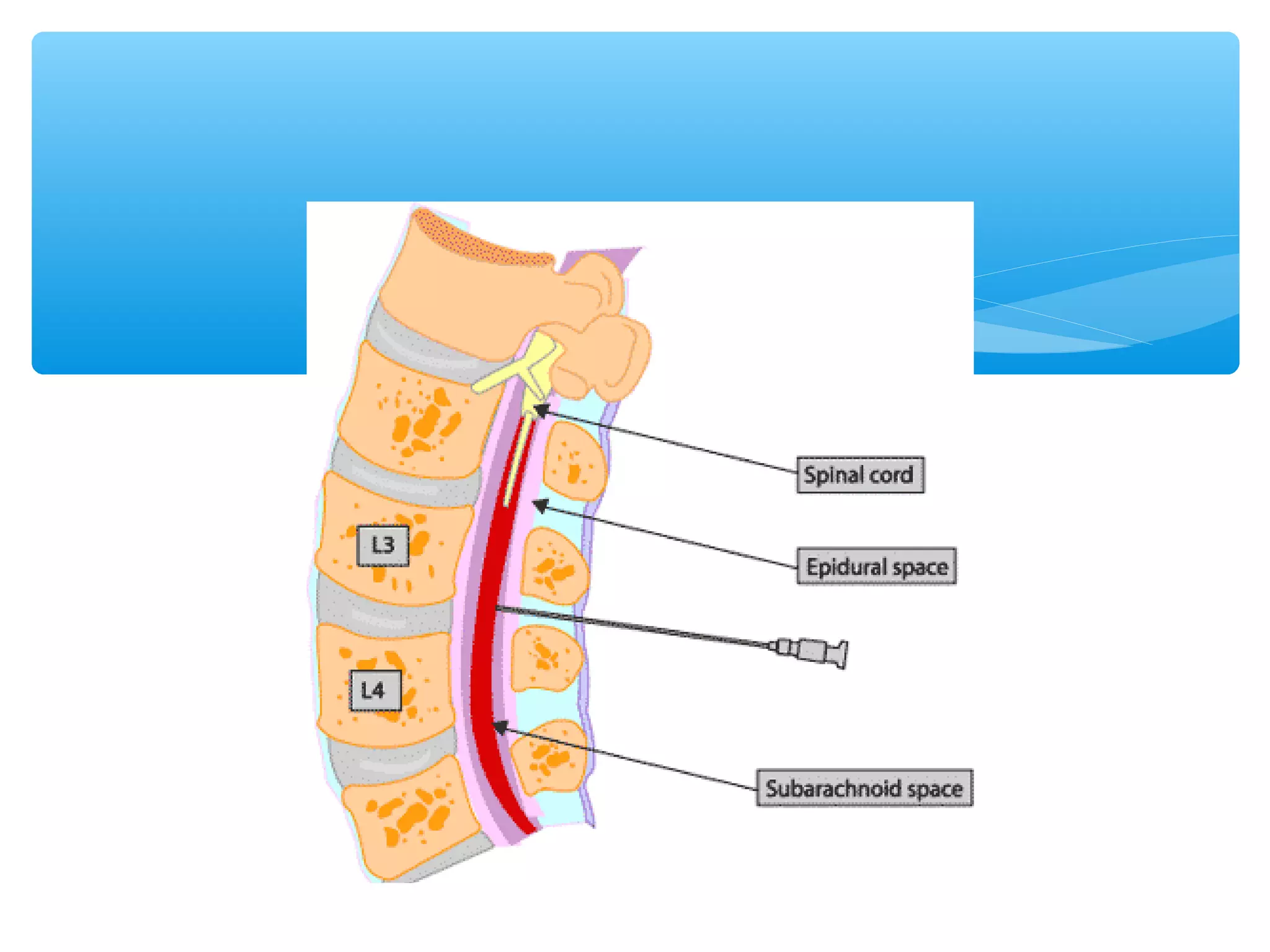 Spinal anesthesia | PPT
