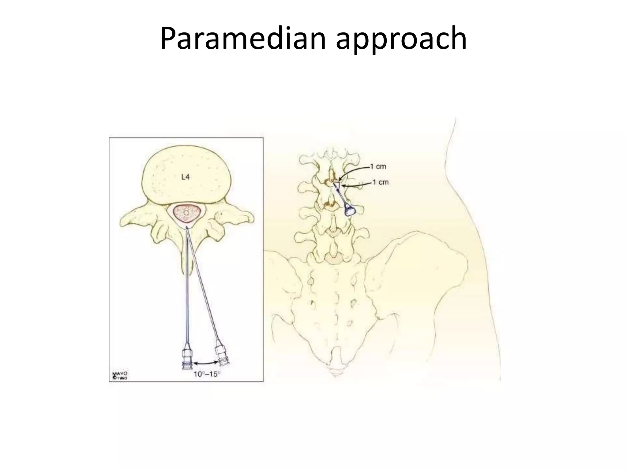 Spinal anesthesia | PPTX