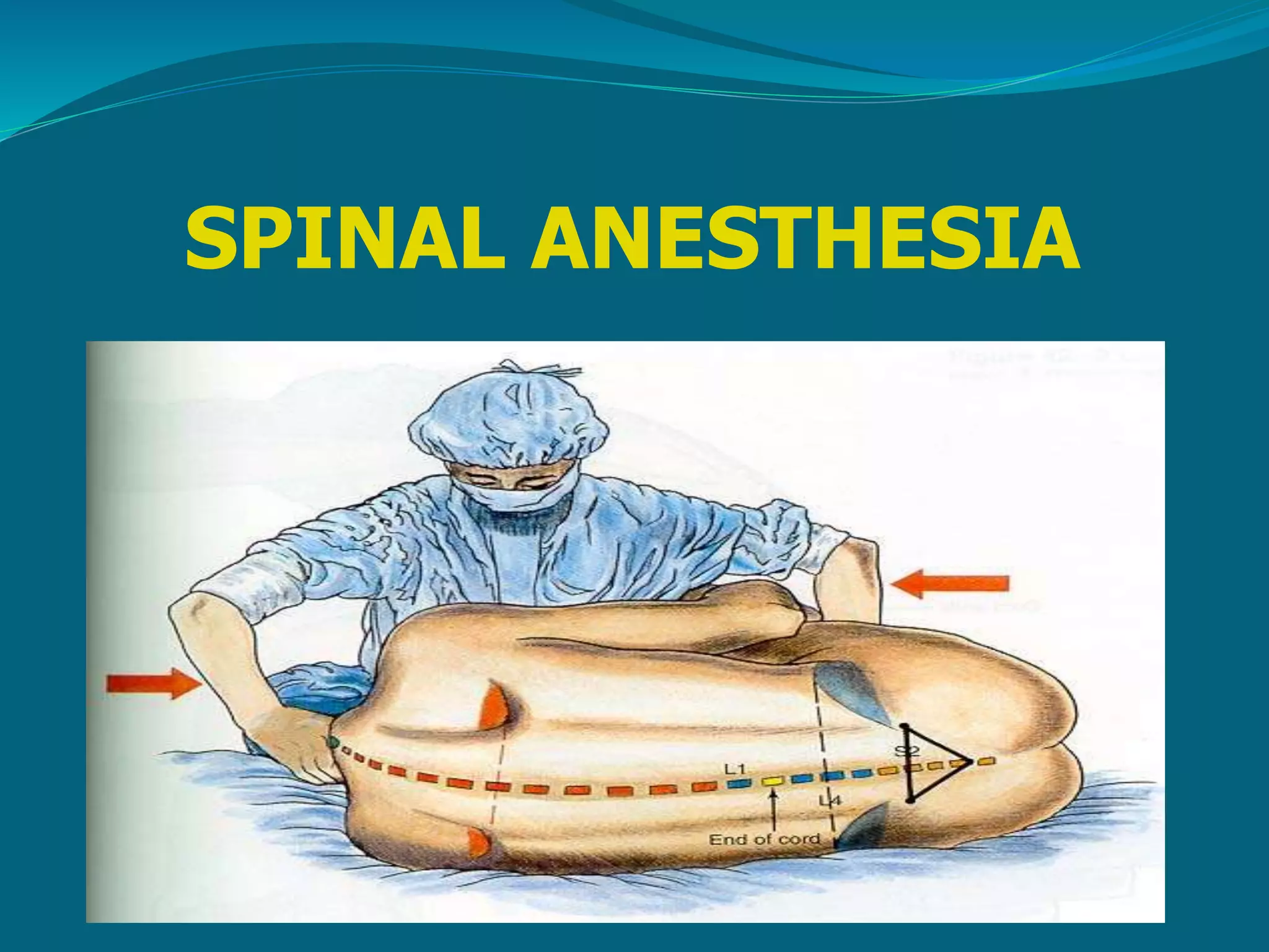 Spinal anesthesia | PPTX