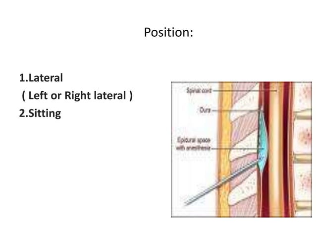 Spinal anesthesia | PPTX