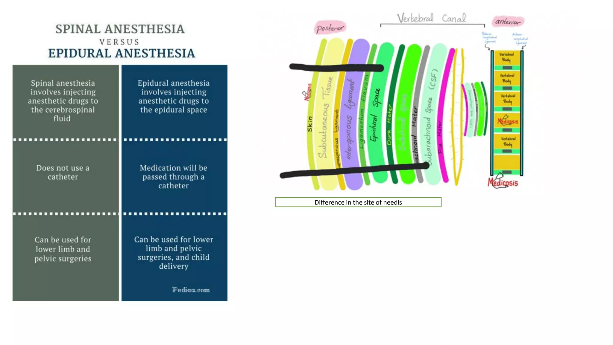 spinal anesthesia | PPT