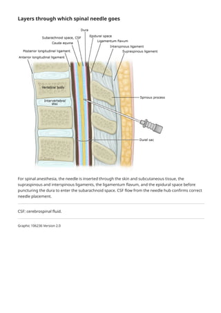 Spinal anesthesia_ Technique - UpToDate.pdf
