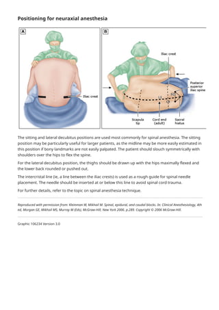 Spinal anesthesia_ Technique - UpToDate.pdf