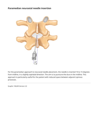 Spinal anesthesia_ Technique - UpToDate.pdf