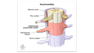 Spinal Arachnoiditis ppt.pptx