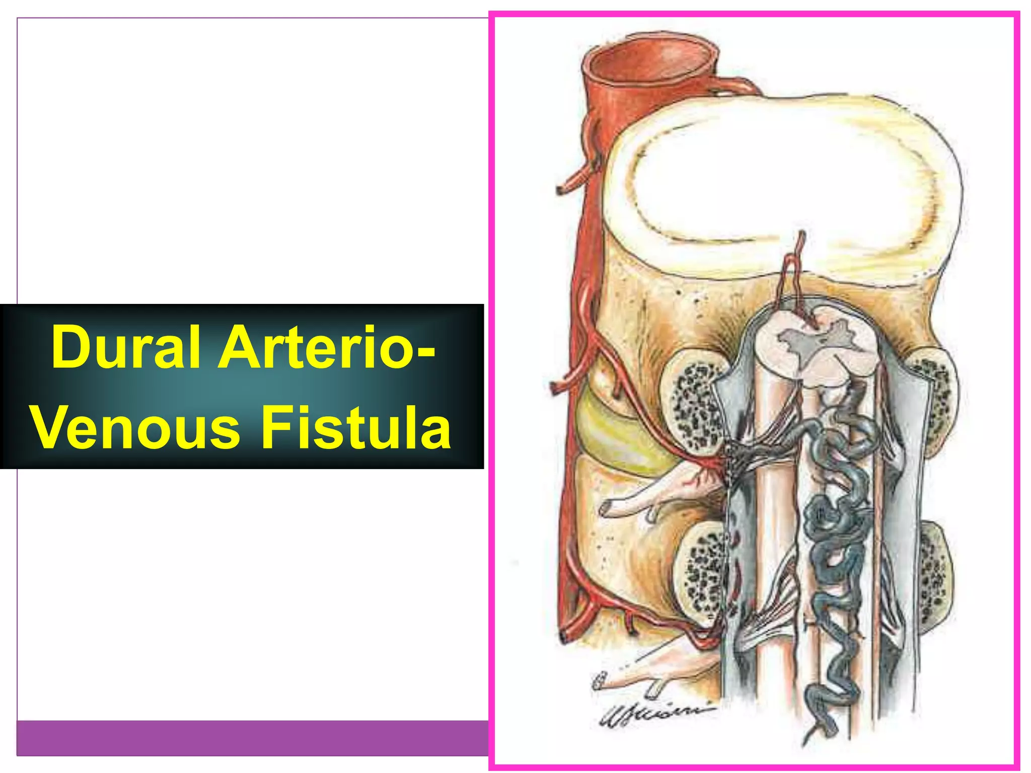 SPINAL CORD ARTERIOVENOUS MALFORMATIONS | PPTX