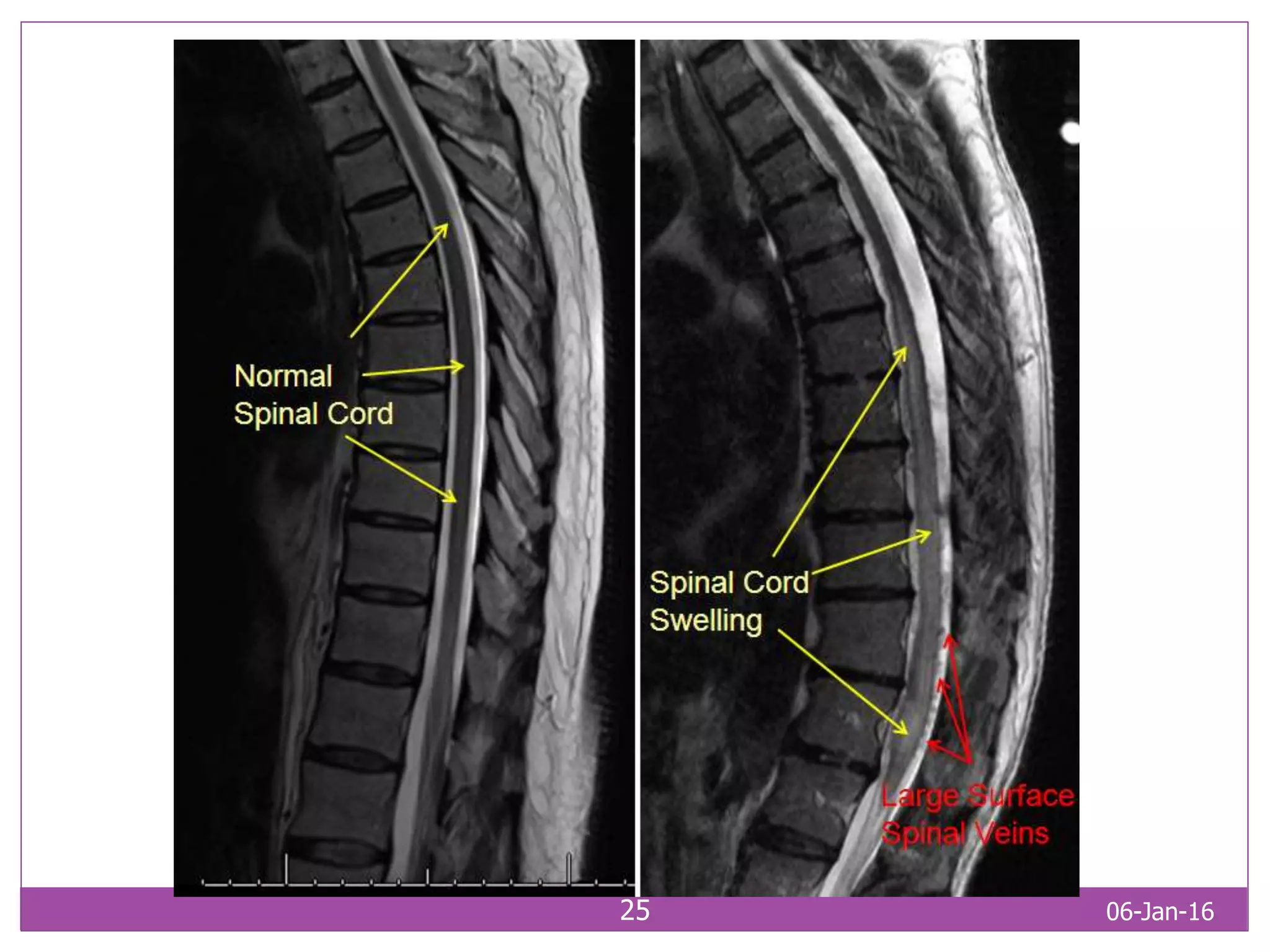 SPINAL CORD ARTERIOVENOUS MALFORMATIONS | PPTX