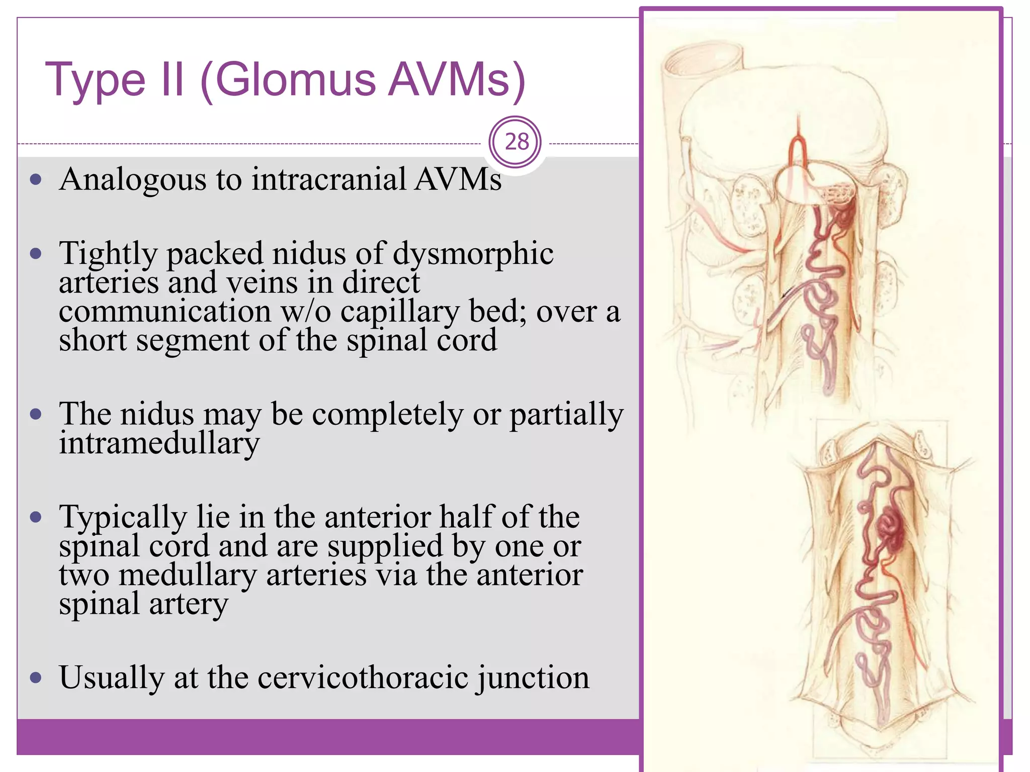 SPINAL CORD ARTERIOVENOUS MALFORMATIONS | PPTX