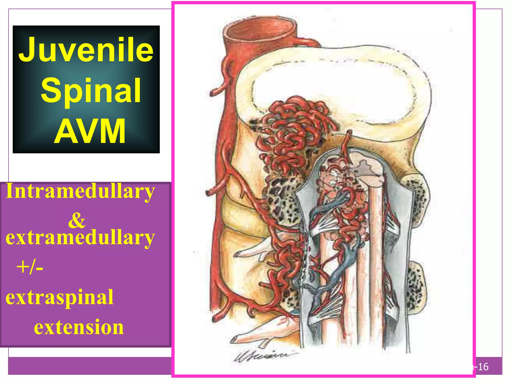 SPINAL CORD ARTERIOVENOUS MALFORMATIONS | PPTX