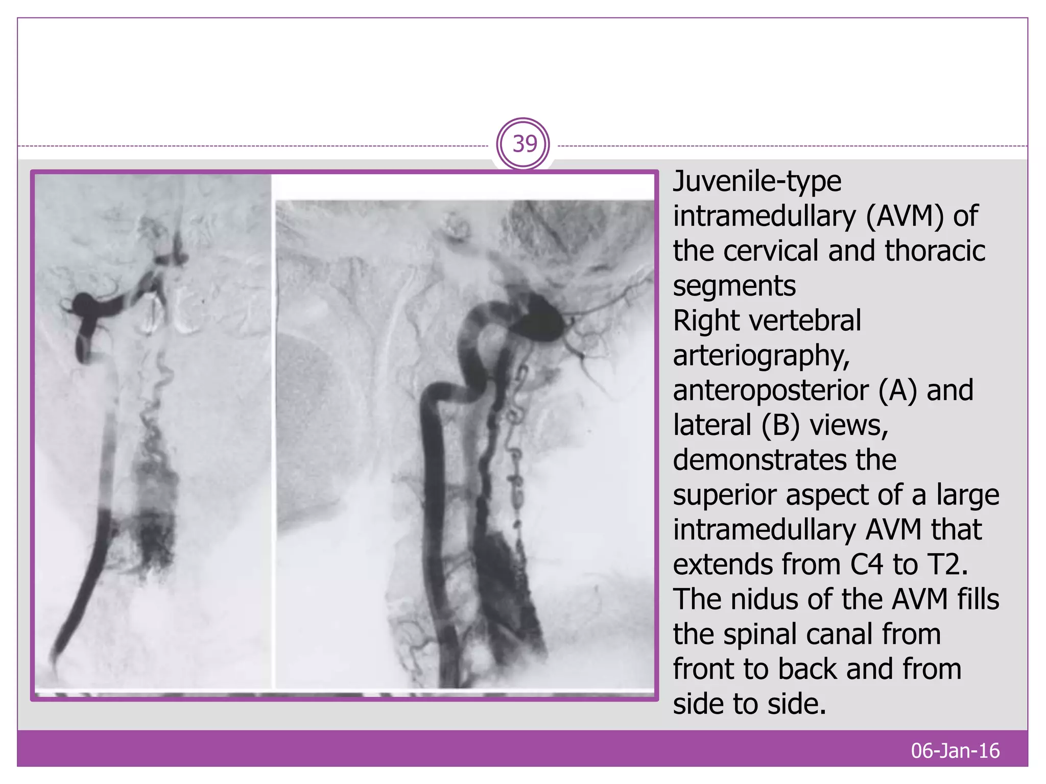 SPINAL CORD ARTERIOVENOUS MALFORMATIONS | PPTX