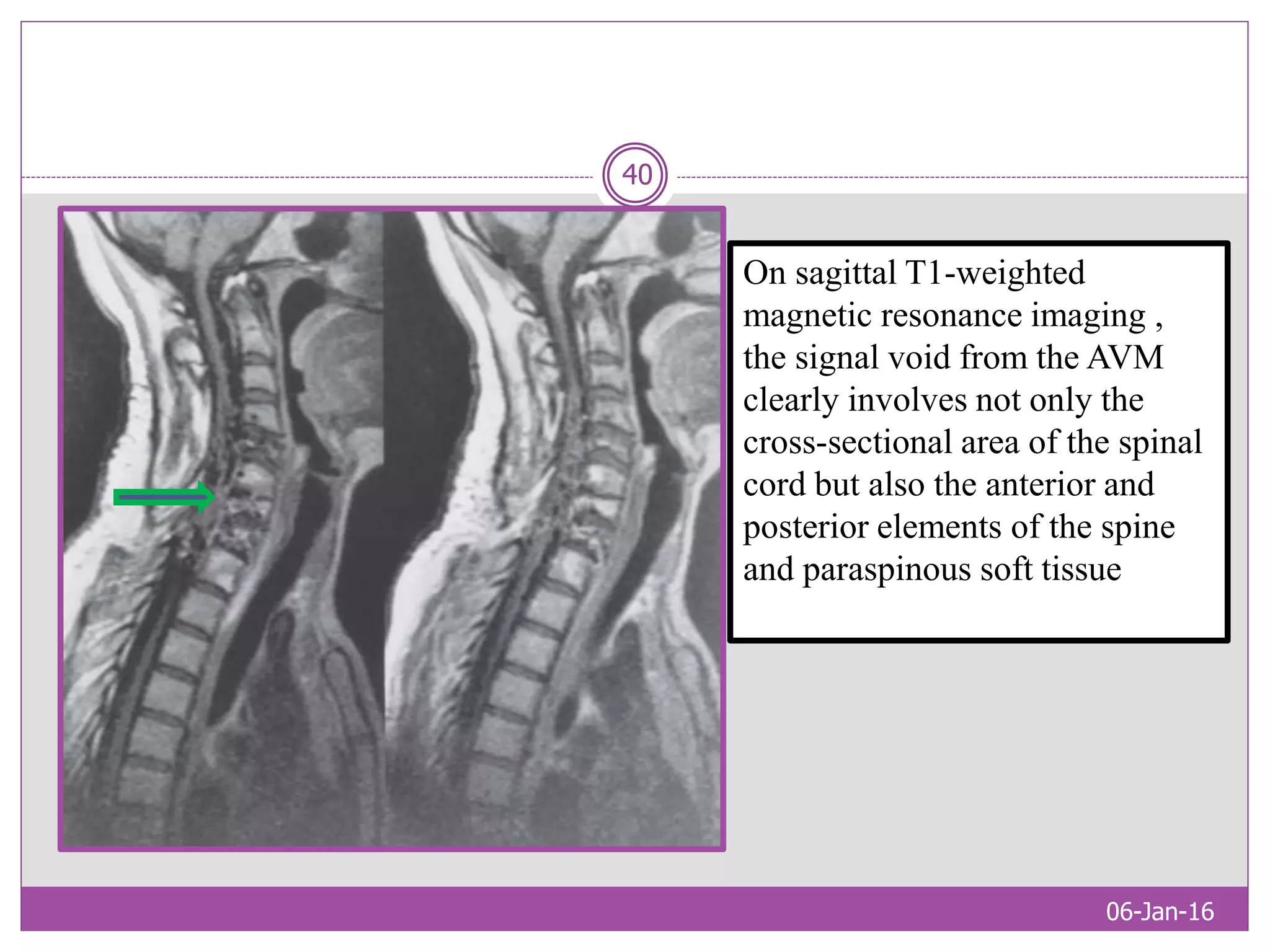 SPINAL CORD ARTERIOVENOUS MALFORMATIONS | PPTX