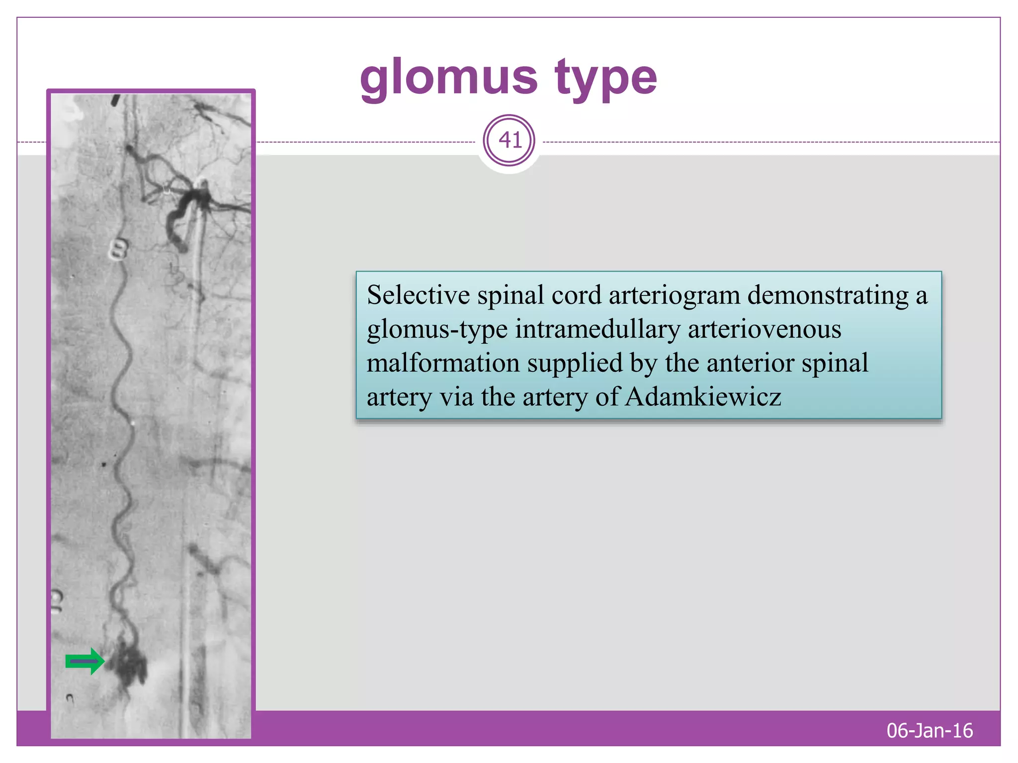SPINAL CORD ARTERIOVENOUS MALFORMATIONS | PPTX