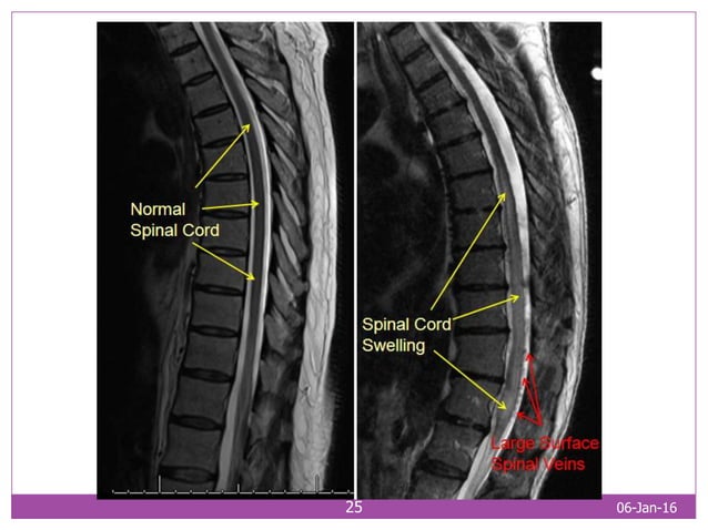 SPINAL CORD ARTERIOVENOUS MALFORMATIONS | PPTX