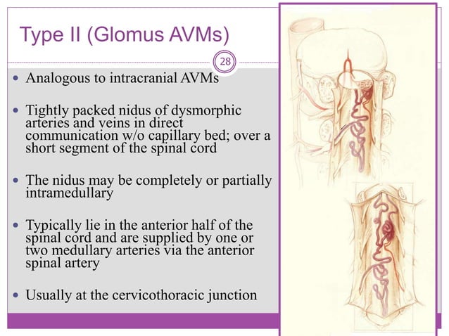 SPINAL CORD ARTERIOVENOUS MALFORMATIONS | PPTX
