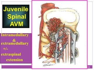 SPINAL CORD ARTERIOVENOUS MALFORMATIONS | PPTX