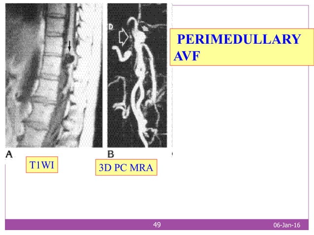 SPINAL CORD ARTERIOVENOUS MALFORMATIONS | PPTX