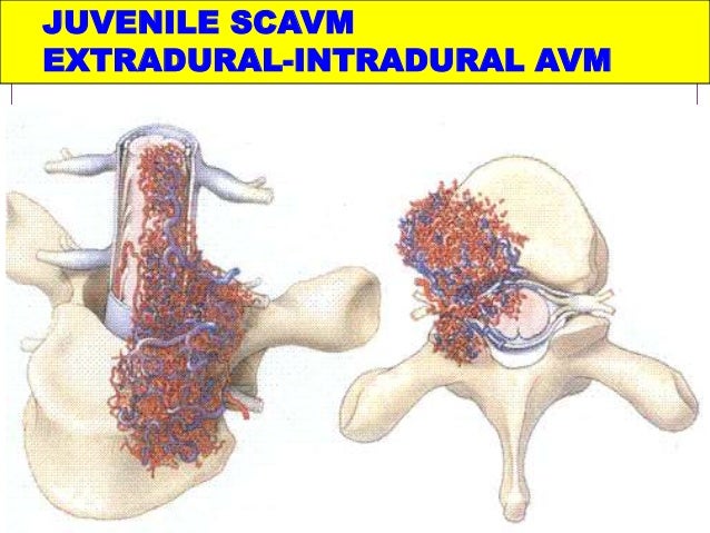 SPINAL CORD ARTERIOVENOUS MALFORMATIONS