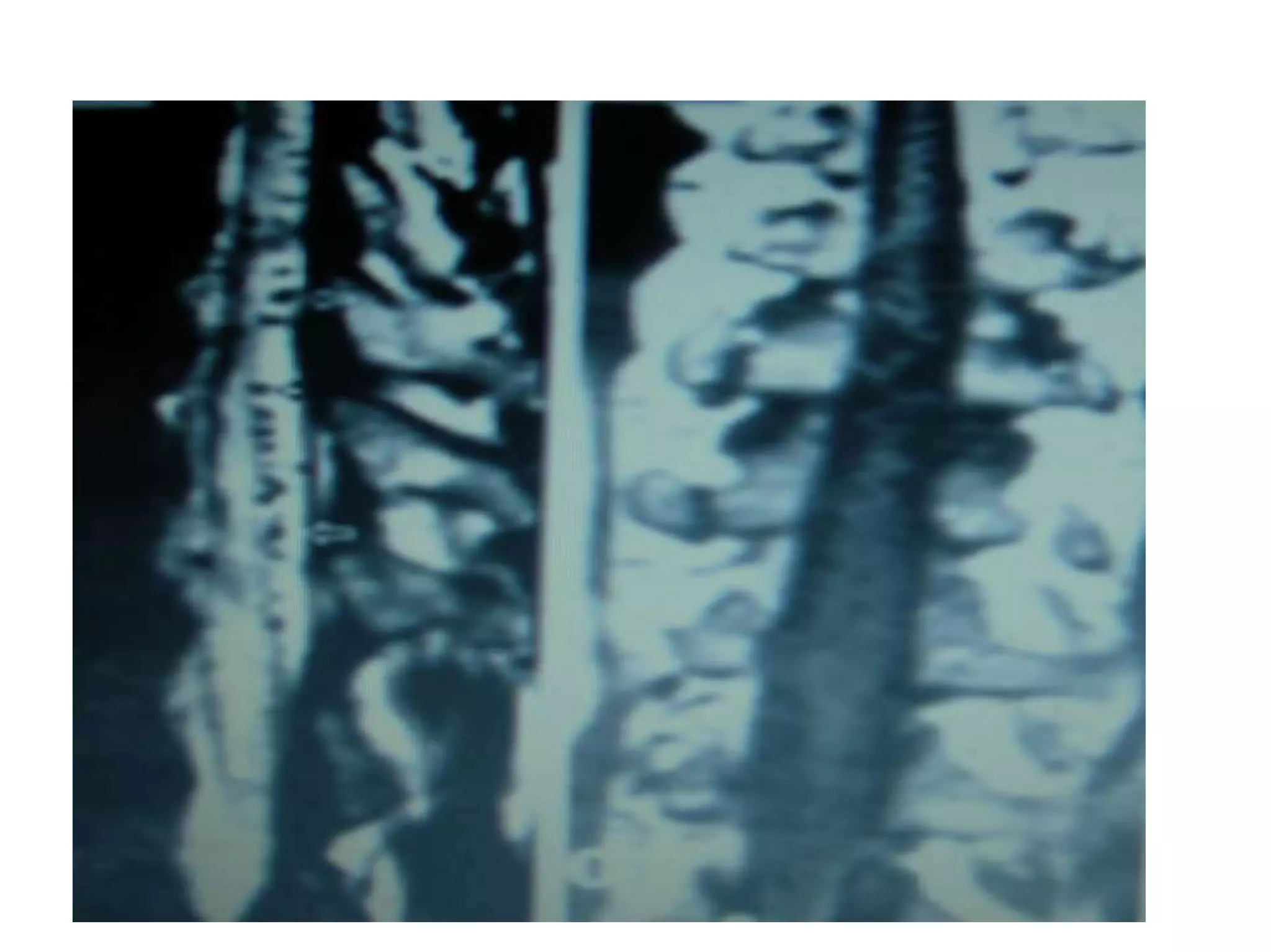 SPINAL AVM.pptx